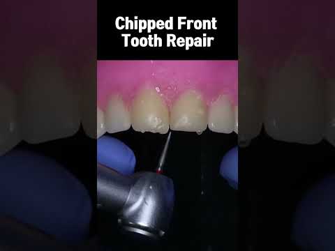 Chipped Front Tooth Repair - Composite Resin #shorts