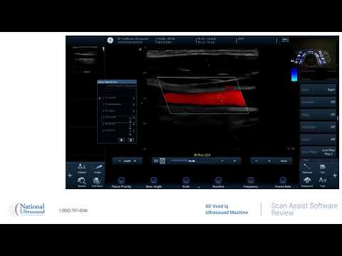 GE Vivid IQ Scan Assist Software Training Video
