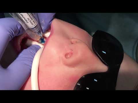 Dental Sealant Application