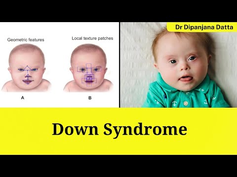 Down Syndrome | Patient Education | MIC