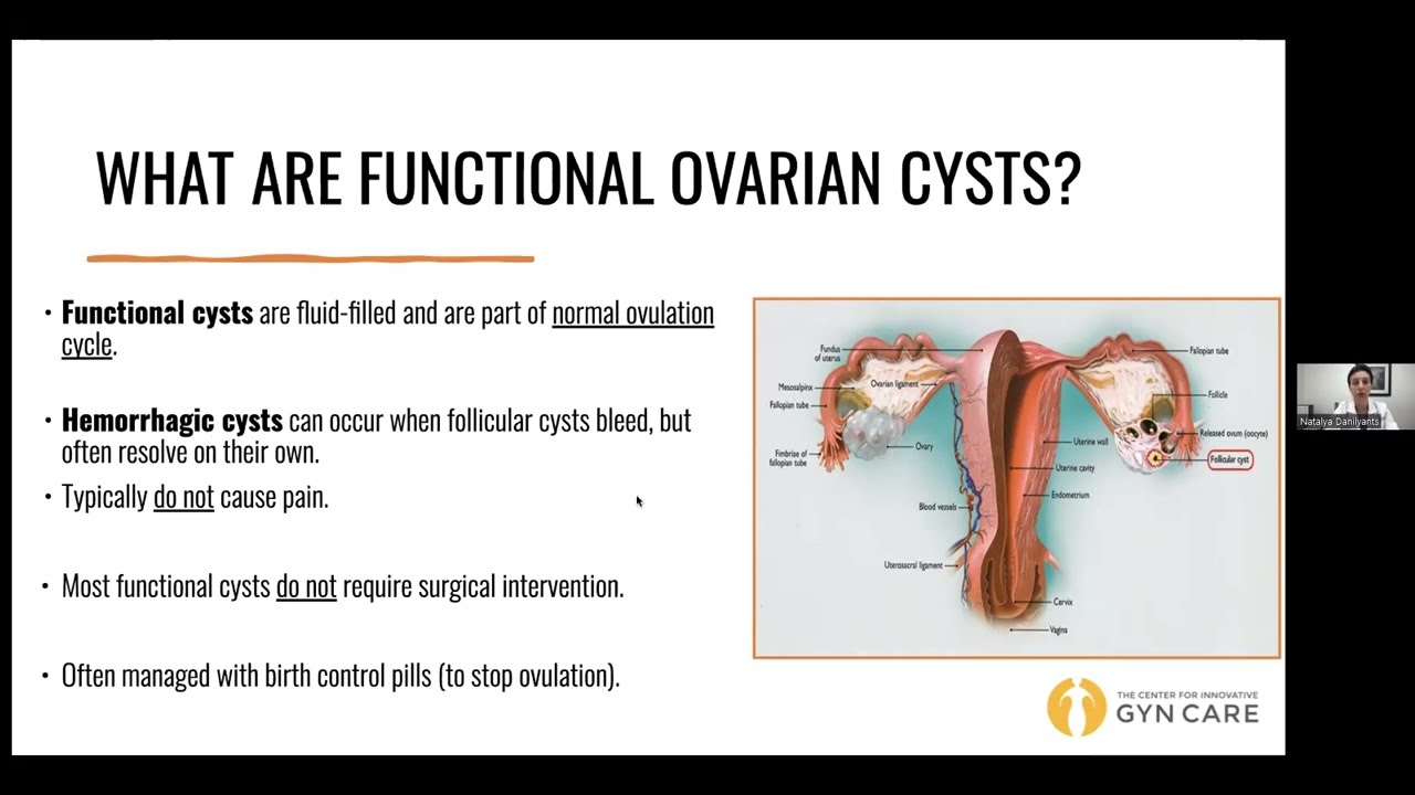Ask the Experts: Unlocking the Mysteries of Pelvic Masses and Ovarian Cysts