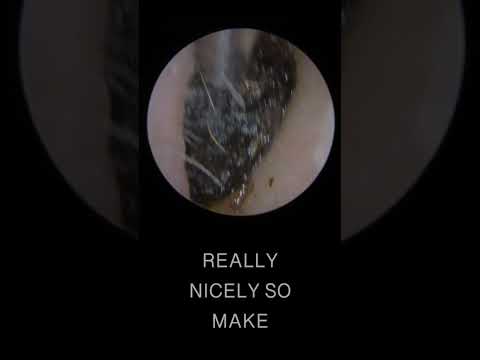 DARK EAR WAX PLUG REMOVAL - TEASER FOR EP 713