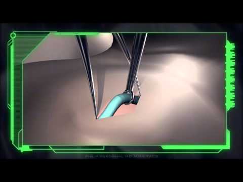 Vasectomy Reversal