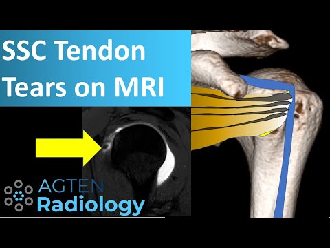 Subscapularis Tendon Tears on MRI