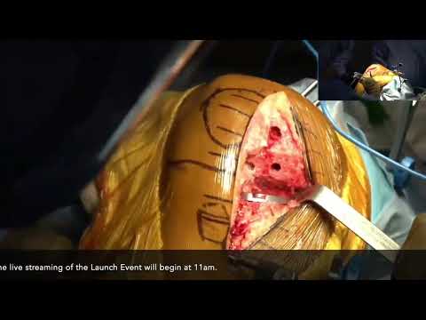 Re-live Robotic Partial Knee Replacement
