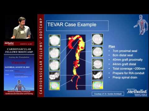 Endovascular Management of Thoracic and TAAA (Brian DeRubertis, MD)