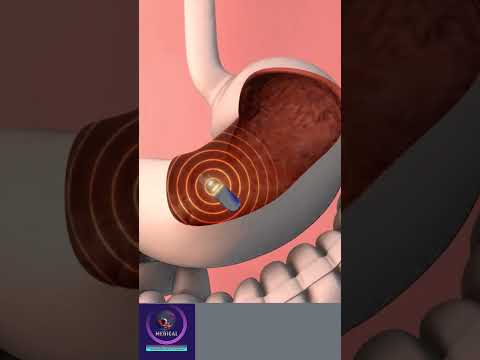 Stomach Endoscopy Procedure - 3D animation