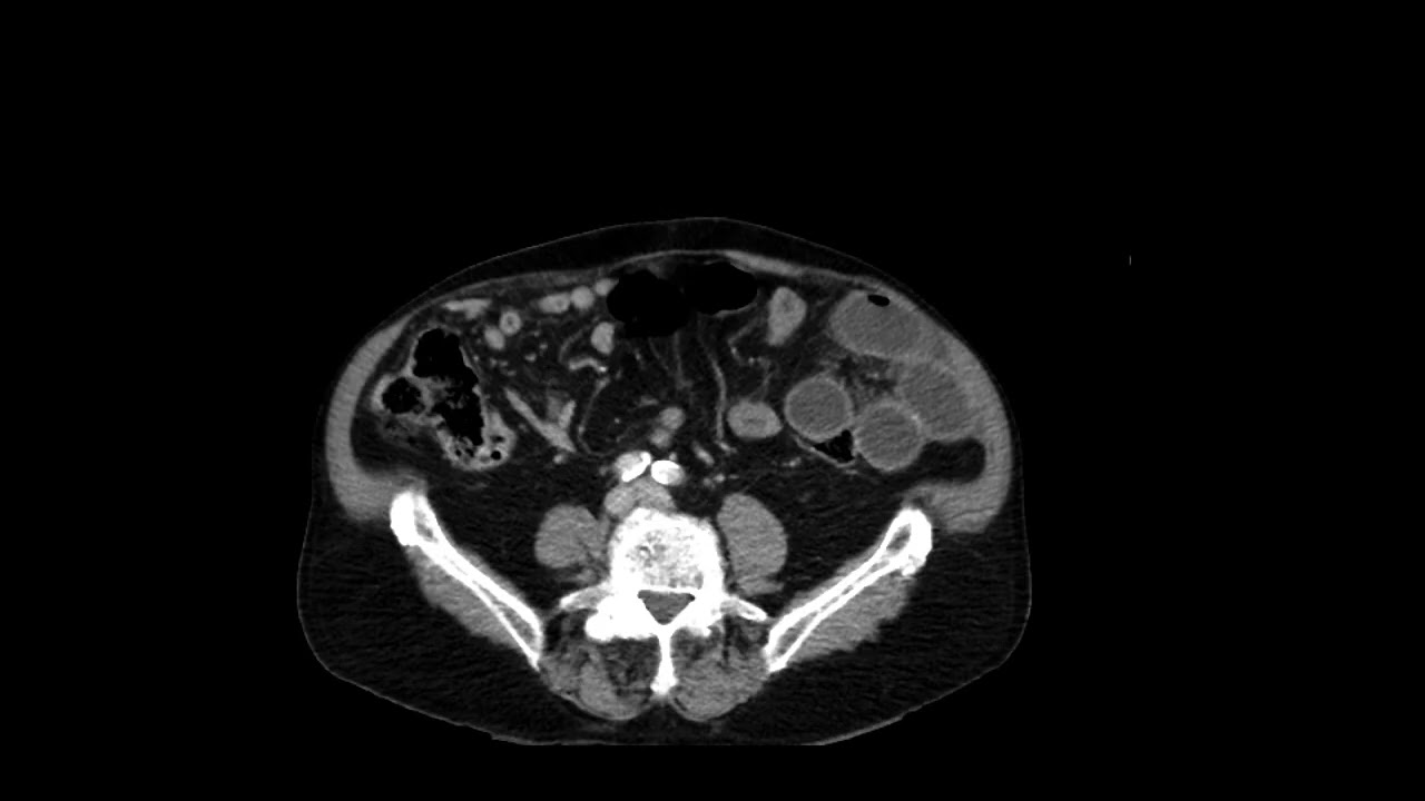 Closed Loop Small Bowel Obstruction
