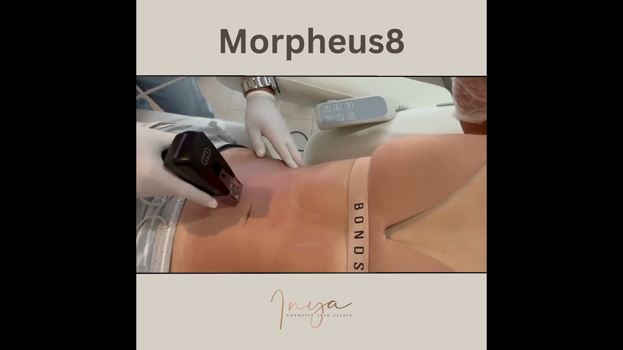 Morpheus8 Body Sculpting