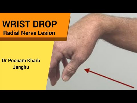 WRIST DROP – Anatomy QA