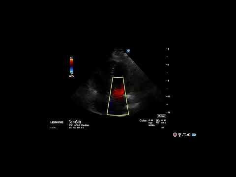 How to...Measure Mitral Stenosis Mean Gradient