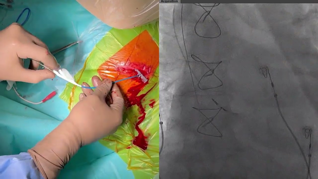 Left bundle branch area pacing with lumenless lead (3830)