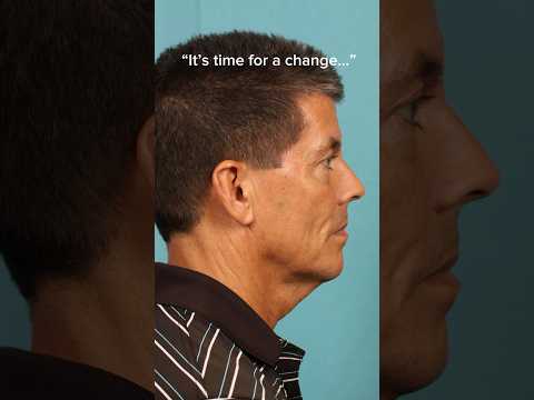 Neck Lift on 64-year old man!🔥🤯 #plasticsurgerybeforeandafter #beforeandafter #ytshorts