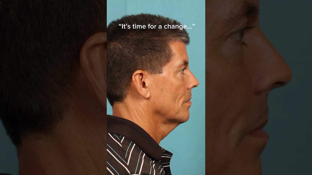 Neck Lift on 64-year old man!🔥🤯 #plasticsurgerybeforeandafter #beforeandafter #ytshorts