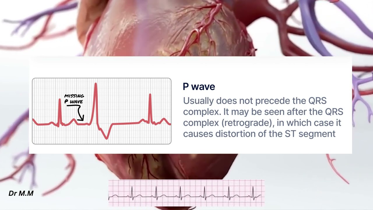 How to Identify PVCs on ECG 🫀 | Ventricular Ectopic Beats Made Simple