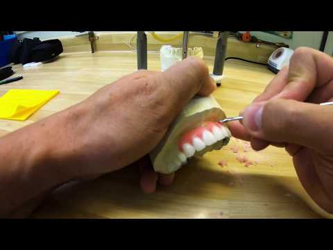 Immediate Partial Maxillary Setup