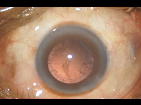Phaco Practice Eyes - Artificial eye for phacoemulsification Latest ...