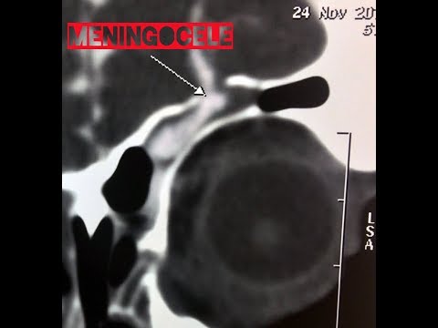 TRANSNASAL ENDOSCOPIC SKULL BASE SURGERY: Meningocele with CSF Rhinorrhea/Leak repair