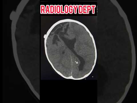 Check VP Shunt | #brain #cthead #nurse #hospital