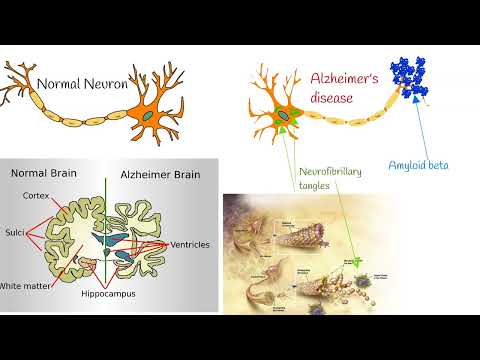 Alzheimer's disease - First Symptoms, Progression and Prognosis