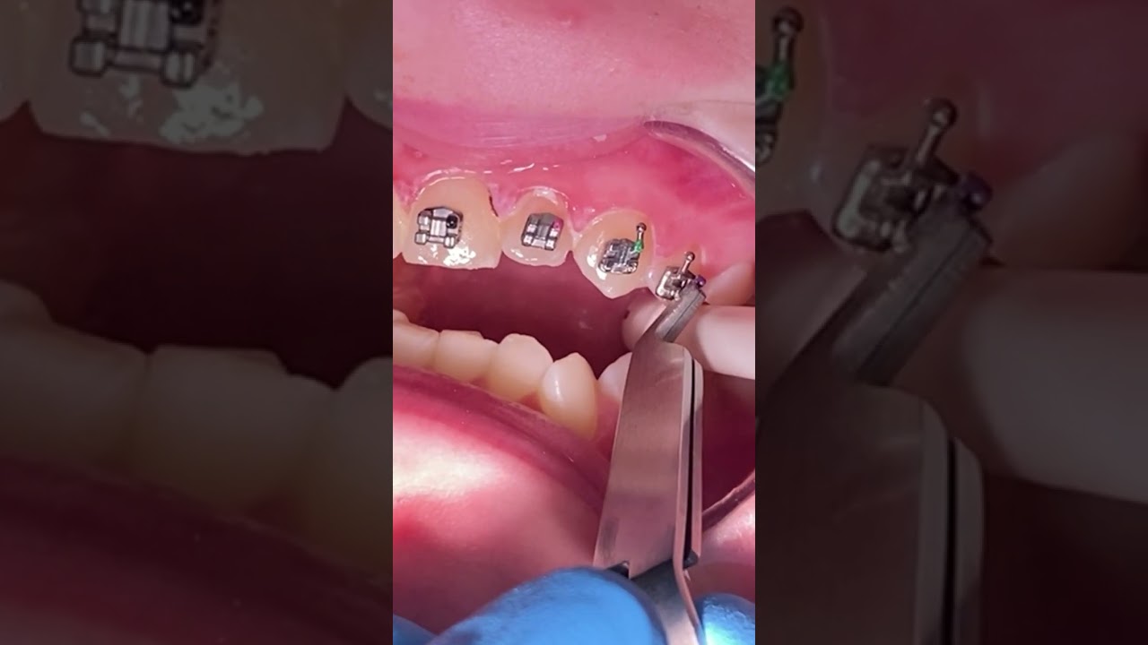 Deep Bite and Braces - Tooth Time Family Dentistry New Braunfels Texas