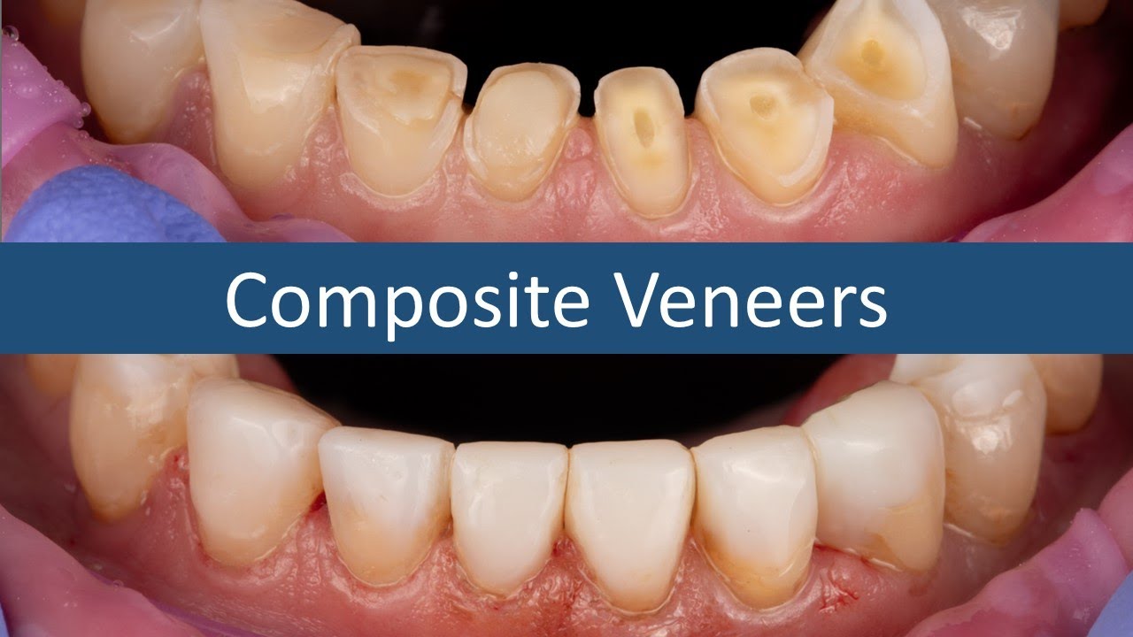 From Worn Teeth to Confident Smile | Composite Veneers + Denture Makeover Redding CA