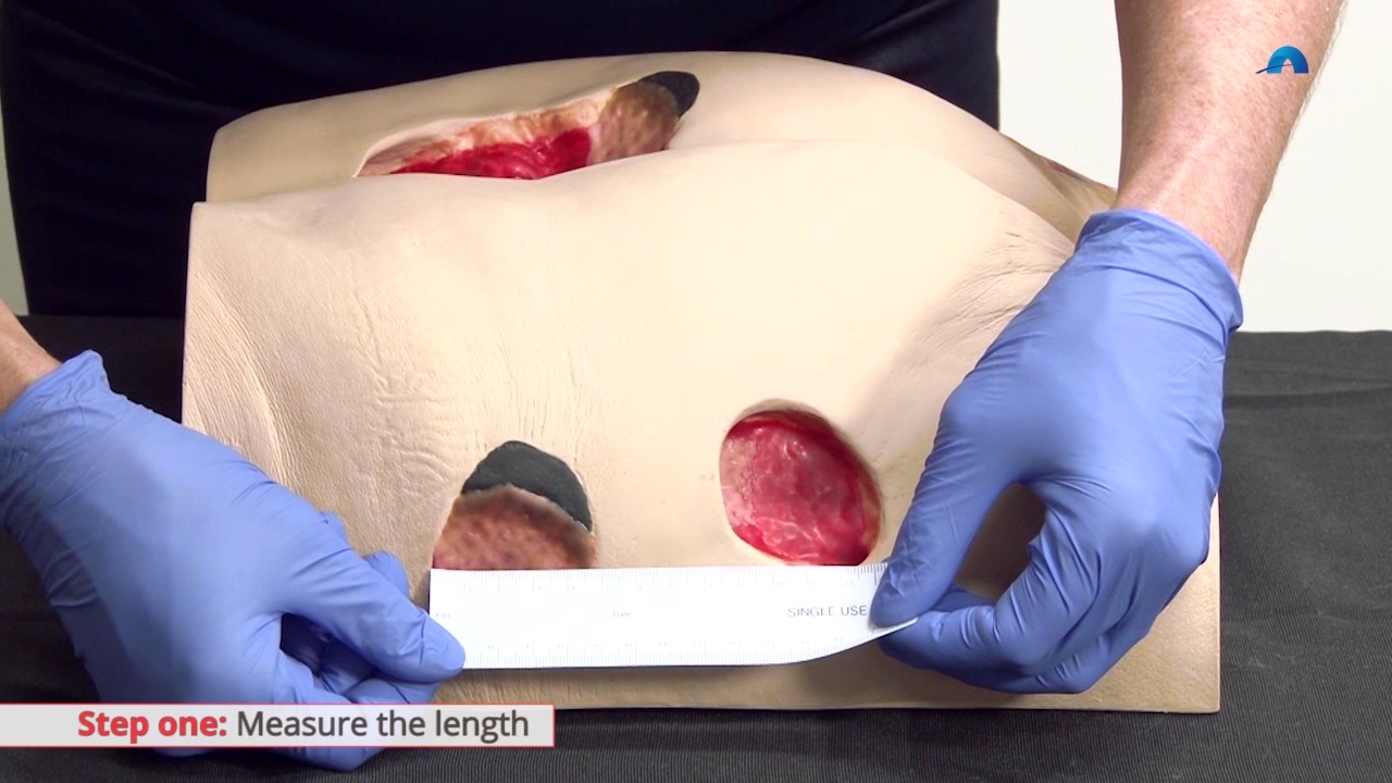How to Measure a Wound | Measuring Wound Dimensions | Ausmed Education