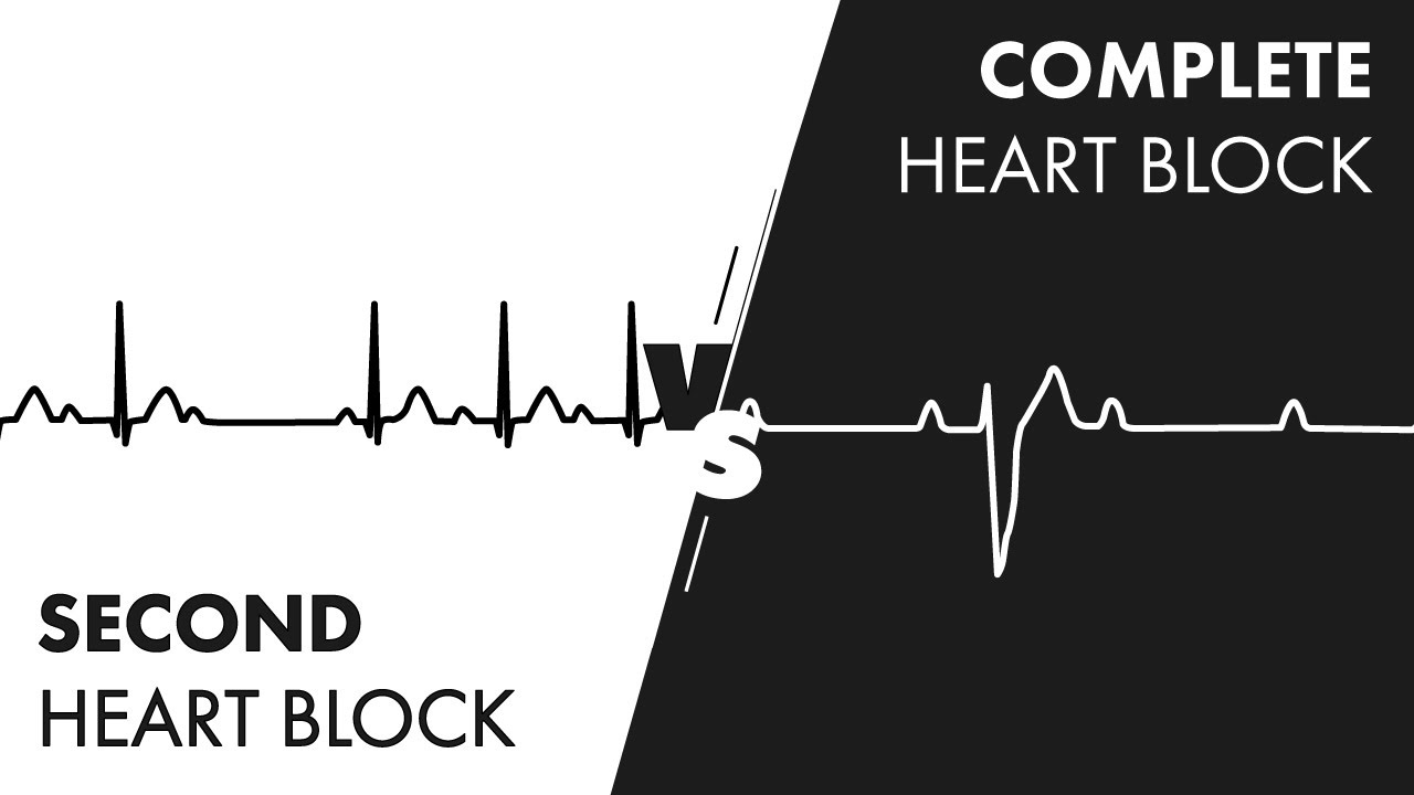 Second vs Third Degree Heart Block - MEDZCOOL