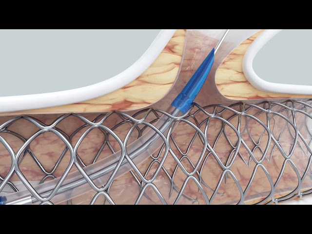 Medtronic - Resolute Integrity Coronary Stent Wholesale Trader from New ...