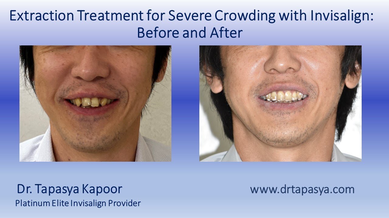 Invisalign Treatment: Class II and Severe Crowding Correction with Premolar Extractions