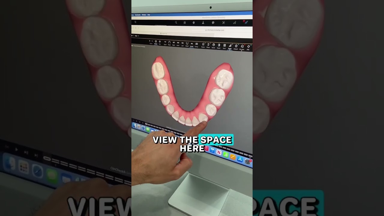Invisalign to close spaces and gaps