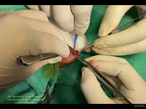Lower lip Mucous retention cyst or Mucocele Enucleation Day Care Surgery
