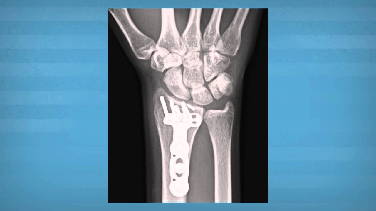 Diagnosing and Possible Treatment for Distal Radius Fracture Explained by Dr. Thomas Trumble