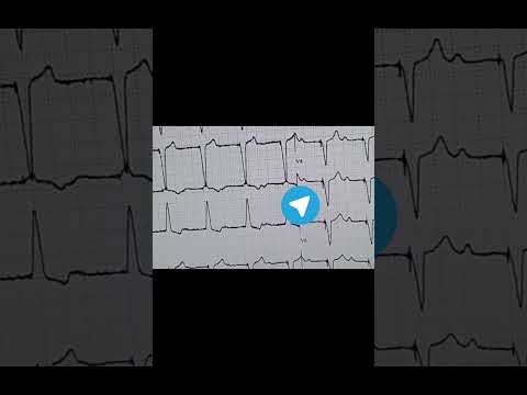 PPM ECG #ppm #pace maker ecg #Heart rate problem #Heart battery #pacemaker #conductionsystem #syncop