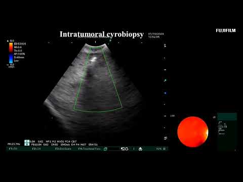 EBUS - Transbronchial Cryonodal Biopsy - Mediastenal paraganglioma
