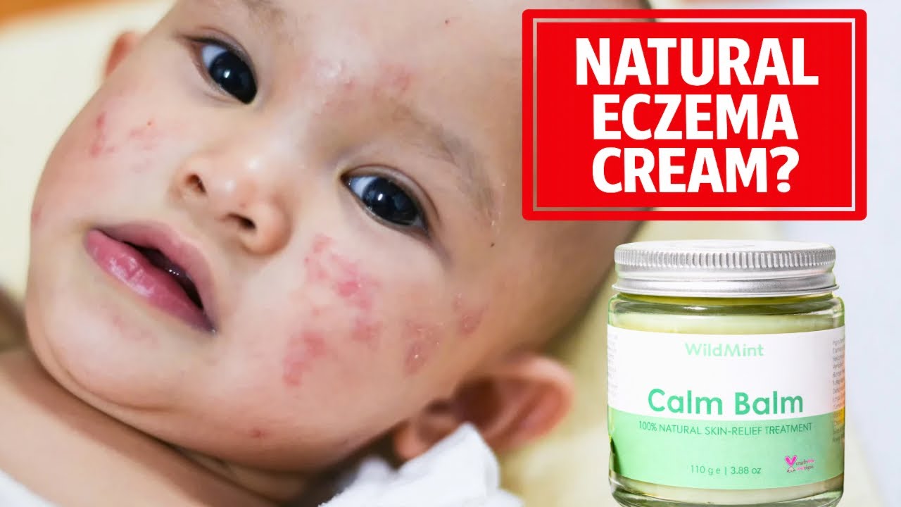 Natural Eczema Cream for Babies — Is It Safe?
