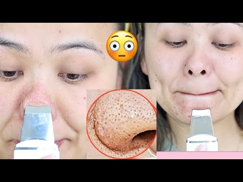 Remove blackheads, cleanse and lift with Agaro Ultrasonic Facial Skin Scrubber
