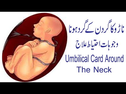umbilical cord around the neck / cord around neck / single loop of cord around neck / umbilical cord