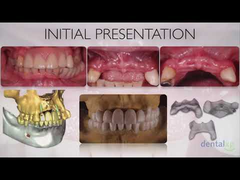 Challenges & Management of Peri Implant Pink Esthetic