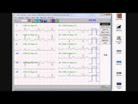 How to Acquire an ECG