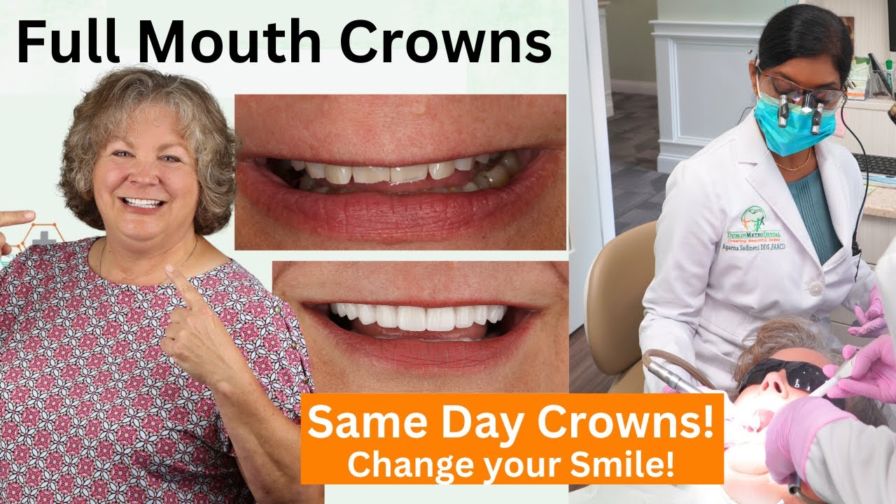 Full Mouth Crowns | Smile Makeover in Dublin & Columbus Ohio | Same Day Smile Makeover