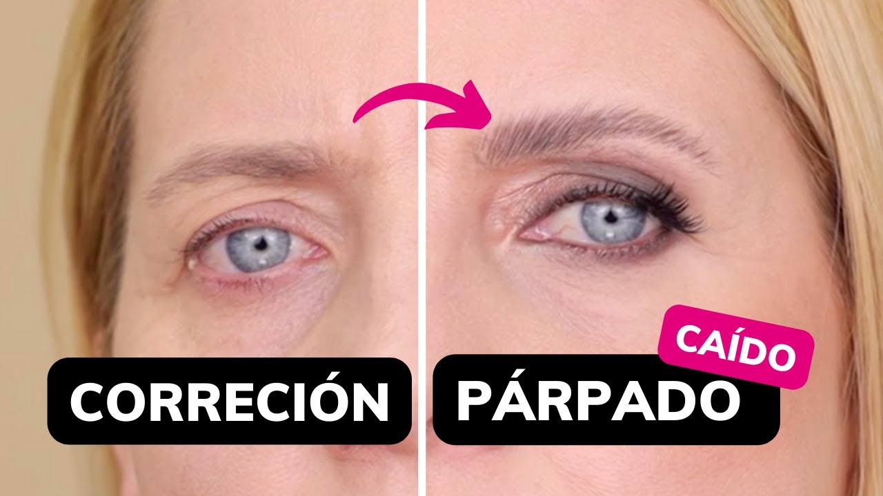 Corrección de párpado caído | Clase Gratuita