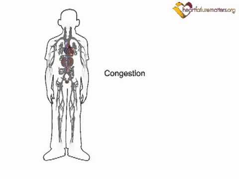 How heart failure causes fluid accumulation - www.heartfailurematters.org
