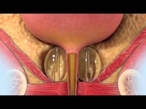 The ProACT Therapy and Male Stress Urinary Incontinence: Patient Education Video