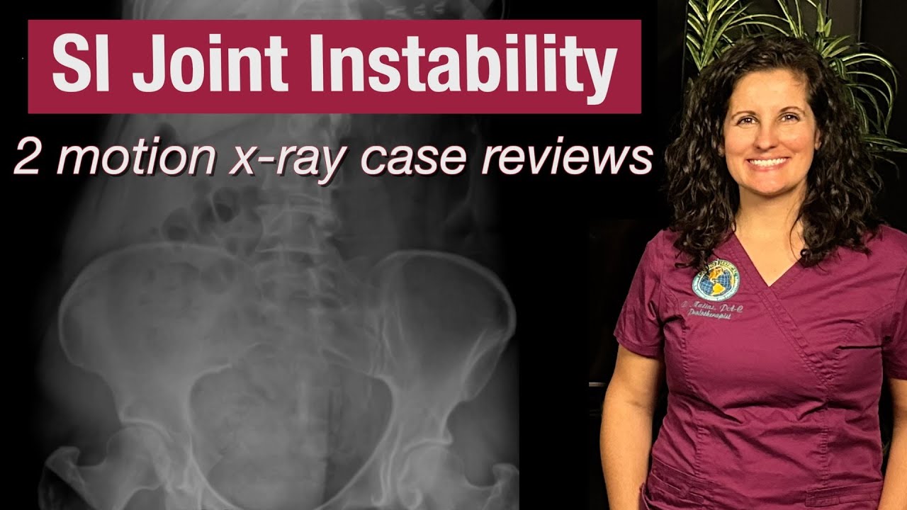 Sacroiliac joint instability seen on motion x-ray- 2 case reviews