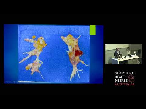Pulmonary Endarterectomy for Chronic Thromboembolic Pulmonary Hypertension - Prof David McGiffin