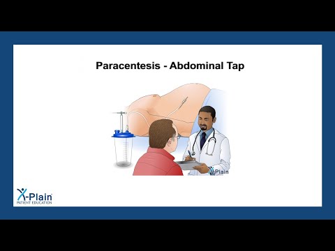 Paracentesis - Abdominal Tap