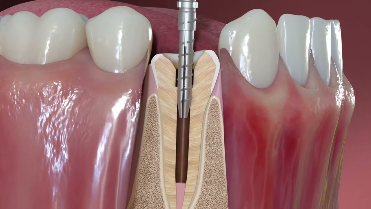 Flexi-Post inserted into the root canal space