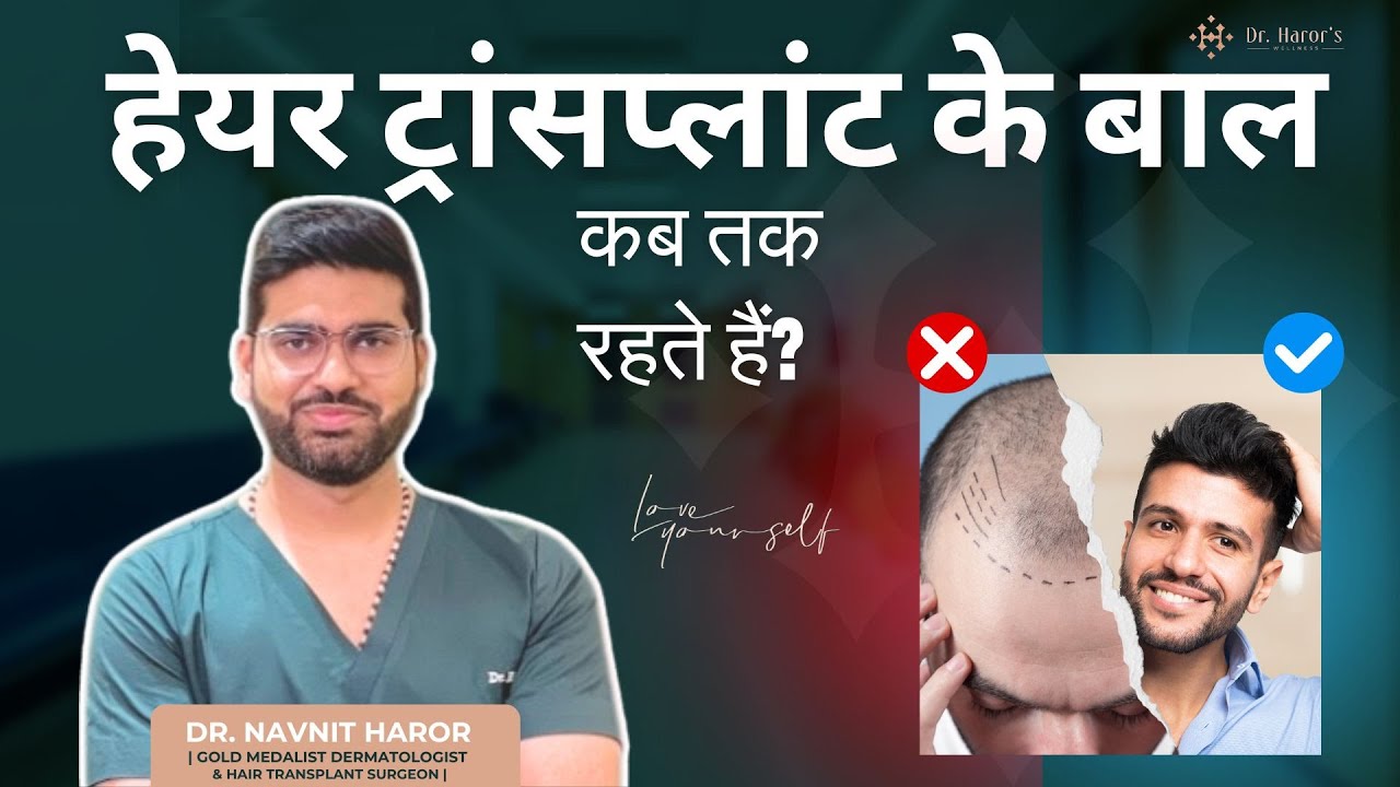 How Long does a Hair Transplant Result Last ? Best Hair Transplant Surgeon explained..