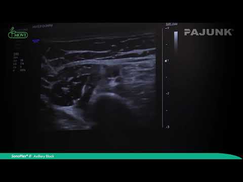 Axillary Block with SonoPlex® II Nerve Block Procedure